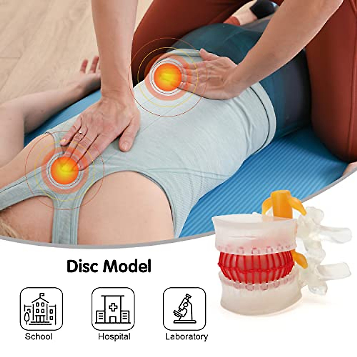MIIRR Human Lumbar Disc Herniation Model, Transparent Medical Model of Vertebral Spine Anatomy with Elastic Software, Perfect for Learning and Teaching Tool