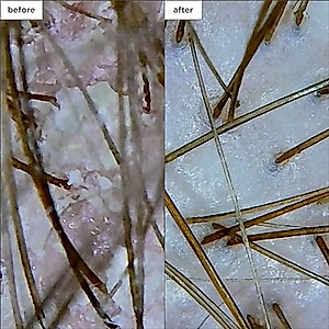 Briogeo Scalp Revival Megastrength Dandruff Shampoo, Charcoal + AHA/BHA with Salicylic Acid 3%, Anti-Dandruff Shampoo to Soothe a Dry, Flaky, Itchy Scalp, Vegan, Cruelty-Free, 8.4 fl oz