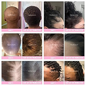 Tru Bloom Hair Growth Vitamins - 1 Month Supply. Clinically Proven for Fuller, Thicker Hair. Natural & Drug-Free. Ultimate Hair Vitamins for Proven Results