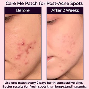 Micropoints for Acne Dark Spot Treatment - Post-Blemish Dark Spots Removal Patch with 127 Mircropoints, Fade & Brighten Post Acne Marks or Dark Spots (9 count/pack)