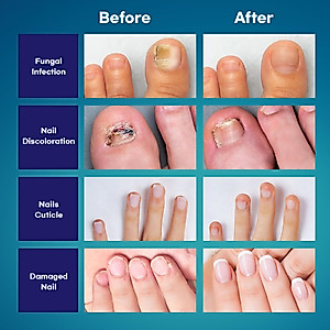 Toenail Fungus Treatment Extra Strength, Nail Fungus Treatment, Nail Fungus Treatment for Toenail & Fingernails, Fungal Nail Treatment for Toenails, Antifungal Nail Treatment for Broken Nail(1oz)