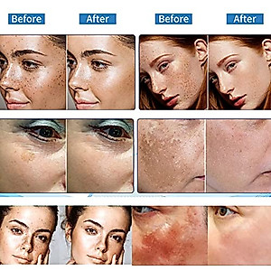 Paradise Emerald Dark Spot Remover for Face, Hyperpigmentation Treatment, Melasma, Freckle, Sun Spots Removal for All Skin Types Dark Spot Corrector for Men and Women