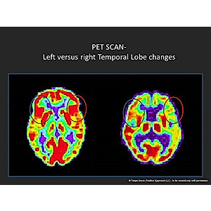 "Understanding Frontotemporal Dementias (FTDs)" 2-DVD Set with Dementia Trainer Teepa Snow
