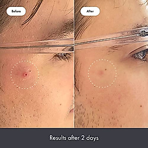 Rescue Balm Post-Blemish Recovery Cream from Hero Cosmetics - Intensive Nourishing and Calming for Dry, Red-Looking Skin After a Blemish - Dermatologist Tested and Vegan-Friendly (50 ml, 1.69 fl. oz)