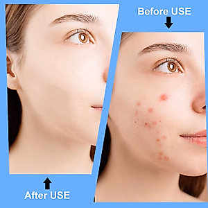 2-in-1 Facial Milia Removal and Whitehead Extractor & Lancet Circle Loop & Sharp Needle Pimple Popper Tool for Nose Face, Blemish Blackhead Extraction Pimple Acne (2pcs)