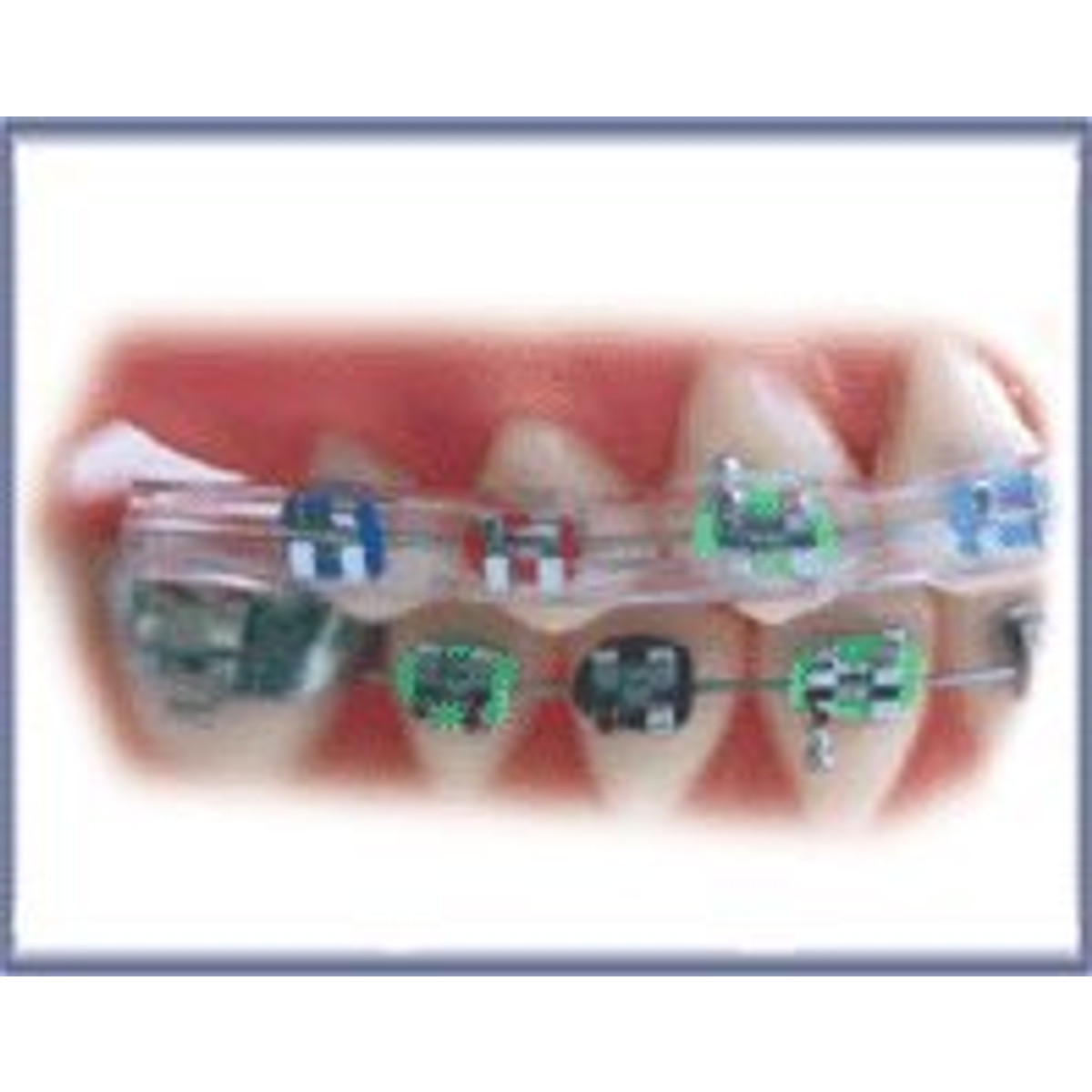 Morgan Bumper Braces Cover Lip Protector Qty 2 - Clear