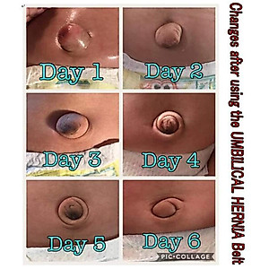 Paskyee Umbilical Hernia Belt Baby Belly Button Band Infant Belly Wrap Abdominal Binder Hernia Truss Support Adjustable Navel Belly Band Newborn Umbilical Cord Blue