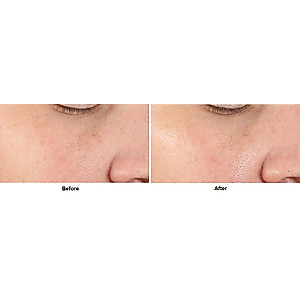 Dr. Dennis Gross Alpha Beta® Pore Perfecting & Refining Serum: for Enlarged, Clogged Pores with Excessive Oil, 1.0 fl oz