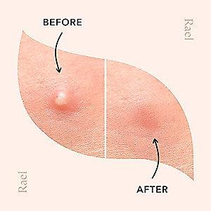 Rael Pimple Patches, Miracle Invisible Spot Cover - Hydrocolloid Acne Pimple Patches for Face, Blemishes and Zits Absorbing Patch, Breakouts Spot Treatment for Skin Care, Facial Stickers, 2 Sizes (96 Count)