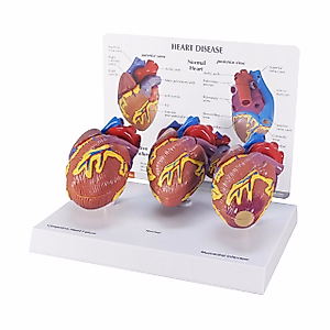 Heart Model Set | Human Body Anatomy Replica Heart Disease Set for Doctors Office Educational Tool | GPI Anatomicals
