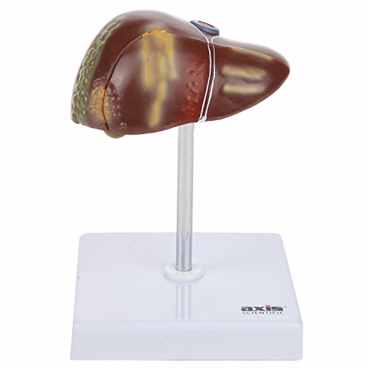 Axis Scientific Anatomy Model of Diseased Liver | Model is 1/3 Life-Size and Divides in 2 Parts | Shows 6 Liver Diseases and Abnormalities | Comes on a White Base