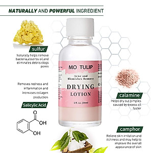 MO TULIP Acne Drying Lotion, Overnight Acne Acid and Acne Spot Treatment for Face and Body, Pimple Lotion Spot Treatment, Dry Out Pimples, Blemishes, and Clean pores (1OZ)