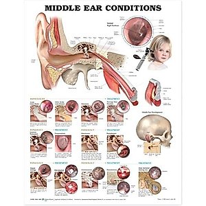 Middle Ear Conditions Anatomical Chart