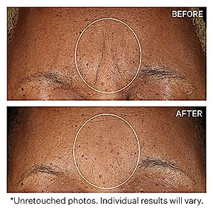 StriVectin Anti-Wrinkle SD Advanced PLUS Intensive Moisturizing Concentrate for Wrinkles and Stretch Marks with Collagen-Targeting Technology, 2 Fl Oz