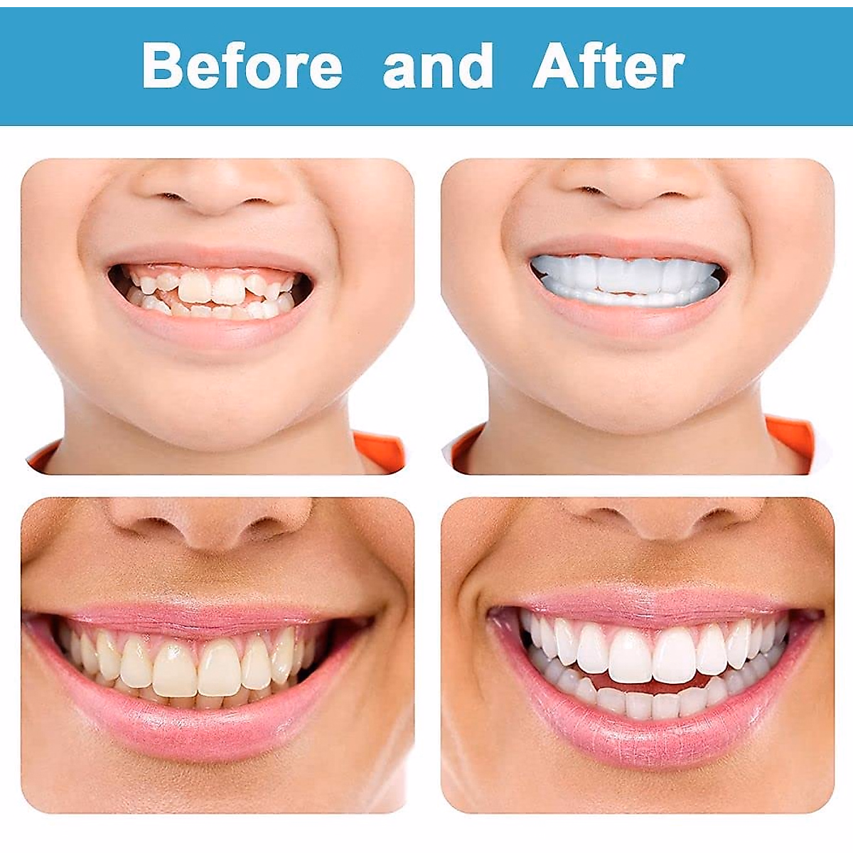Top and Bottom Fake Teeth Cover the Broken and Missing Tooth Snap on Instant & Confidence Smile