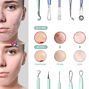 Pimple Popper Tool Kit, MENOLY 10Pcs Blackhead Remover Extractor Tools, Acne Kit for Blackhead,Blemish,Zit Removing, Whitehead Popping and Comedone Extractor Tool with Leather Bag