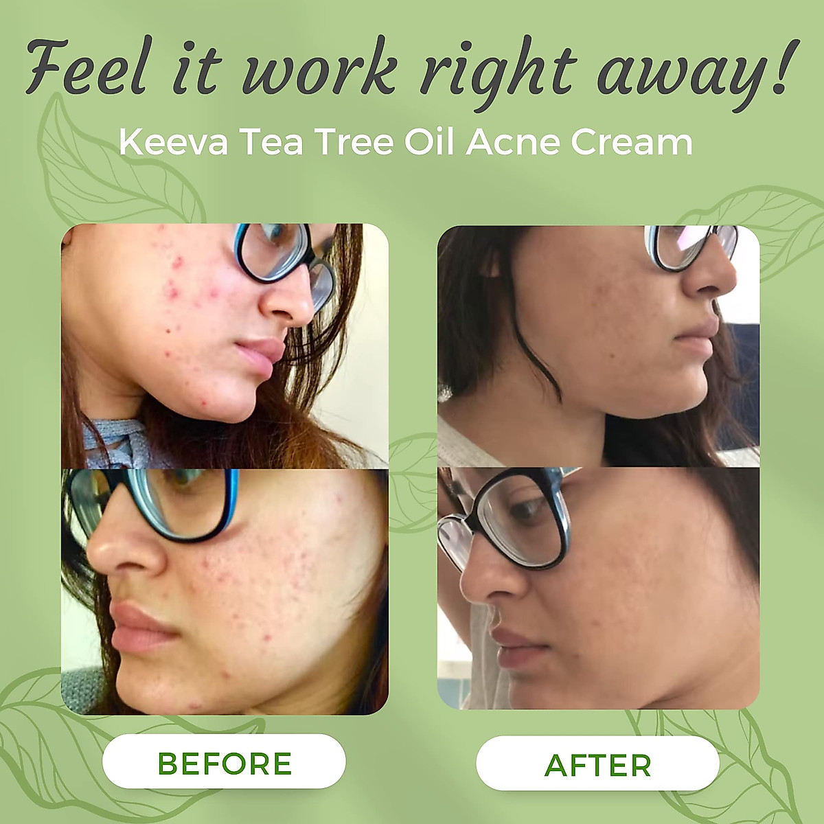 Keeva Organics Acne Treatment Cream With Secret TEA TREE OIL Formula - Perfect For Acne Scar Removal, Fighting Breakouts, Spots, Cystic Acne - See Results in Days Without Dry Skin (1oz)