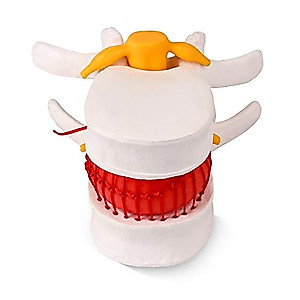 MIIRR Human Lumbar Disc Herniation Model, Vertebral Spine Anatomical Medical Model Perfect for Learning & Teaching Tool - Lumbar Vertebral Spine Model