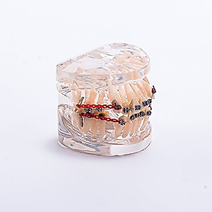Easyinsmile Dental Orthodontic Treatment Model Teeth/Tooth/Denture Model with Braces for Dentist Studying Researching and Patient Education (Metal Bracket)