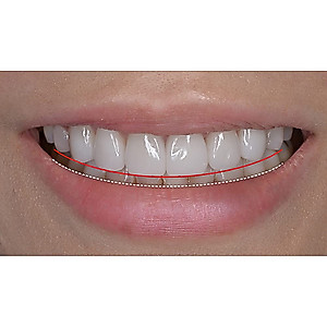 New Silicone Gel Smile Upper and Lower Cosmetic Teeth Tooth Cover Perfect Smile Veneers Comfort Fit Flex molds Mold Denture Braces
