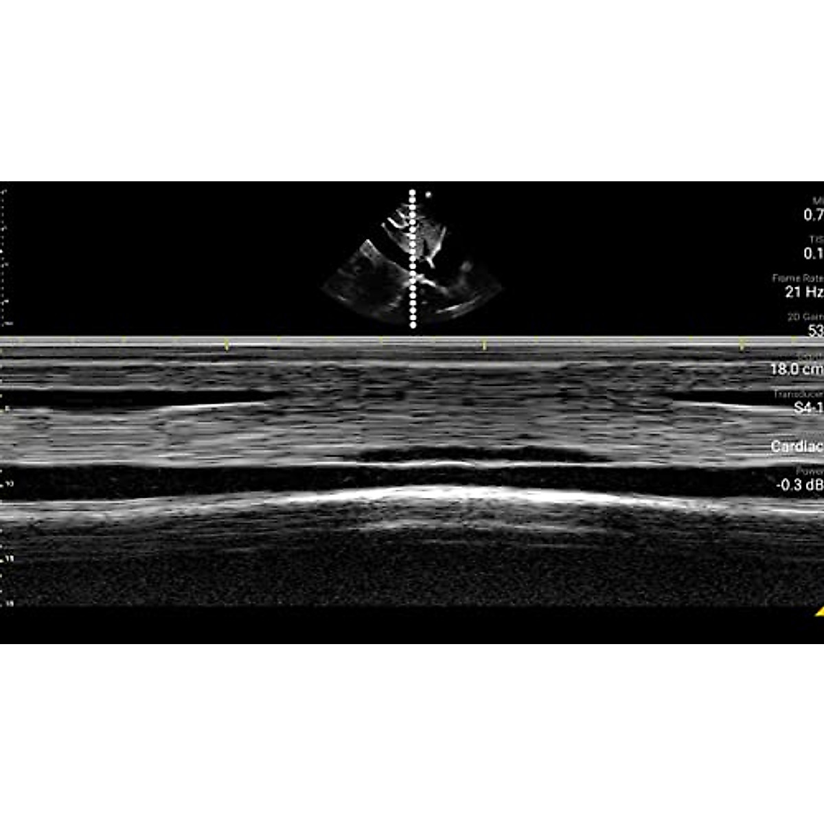 Philips Lumify S4-1 Phased Array Transducer, Portable Ultrasound Solution