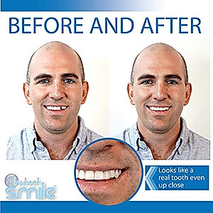 Instant Smile Temporary Tooth Kit -Pro-Series