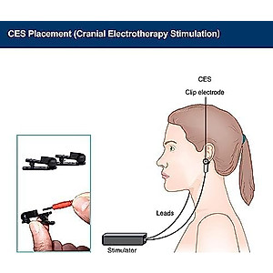 Vagus Nerve Stimulator Ear Clip Compatible with Vagus Nerve Device 2,5 mm Port accompanied by a Vagus Nerve Book