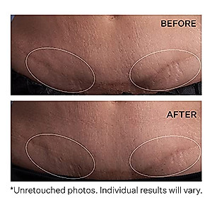 StriVectin Anti-Wrinkle SD Advanced PLUS Intensive Moisturizing Concentrate for Wrinkles and Stretch Marks with Collagen-Targeting Technology, 2 Fl Oz