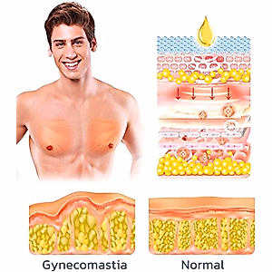 100ml Gynecomastia Tightening Cream,Gynekomastie Reduction Massage Oil,Gynecomastia Tightening Cream,Chest Reduction Massage Oil,Breast Reduction and Tightening Cream (2pcs)