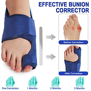 Toe Corrector Toe Separator Bunion Splint 【2024 Updated】 Hallux Valgus Bunion Big Toes Corrector Set Bunion Brace Bunion Exercise Strap Orthopedic Kit Bunion Pain Relief (free, Blue)