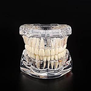 Ultrassist Transparent Disease Teeth Model with Dental Implant Bridge, Dental Model for Patient and Dental Student Education