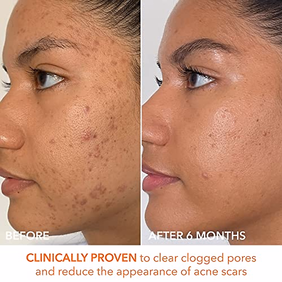 Dr. Dennis Gross Alpha Beta Extra Strength Daily Peel: for Oily Skin, Uneven Tone or Texture, Wrinkles or Enlarged Pores (5 Treatments)