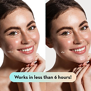 LE GUSHE Korean Pimple Patches for Face (132 Dots) - Hydrocolloid Acne Patches with Tea Tree Oil - Invisible Zit Stickers - Dermatologist Tested - Korean Skin Care