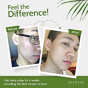 Exposed Skin Care Acne Treatment Kit - Includes Facial Cleanser, Clearing Tonic, Acne Treatment Serum, Clear Pore Serum, Clarifying Mask, Cloth - Natural Acne Solution for Face, All Ages & Skin Types