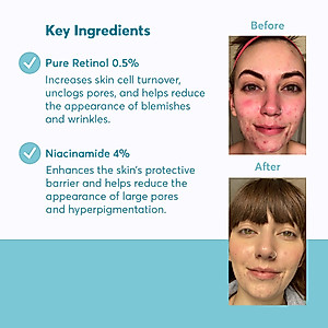 MDacne – Retinol 0.5% and Niacinamide 4% Cream, Reduces Blemishes and Improves Skin Texture without Irritation