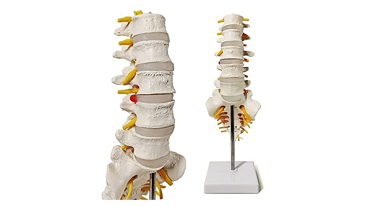 Evotech Lumbar Spine Model with Herniated Disc for Medical Teaching