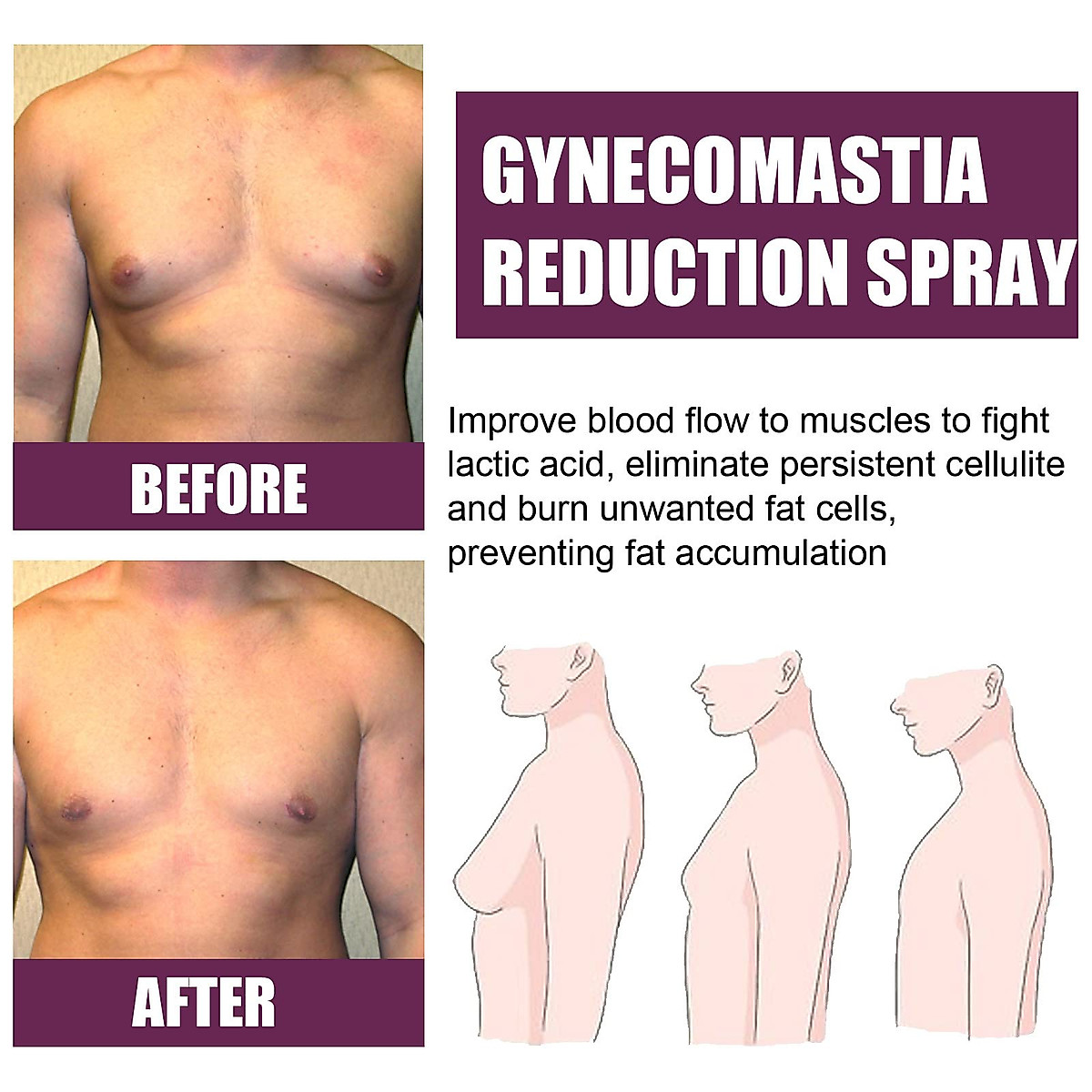 Gynecomastia Reduction Spray, Gynecomastia Chest Tightening Spray Reduction Cellulite Spray, Auchest Chest Cellulite Burner Spray, Prevent Sagging Chest Slim Down (30ml)