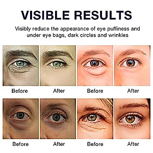 Eye Beauty Instrument, Eye RF Anti Aging Device | Eye Bags | Puffiness | Dark Circles | Crow's feet | Fine Lines | Wrinkles Removal Device, Home Radio Frequency Anti Aging Beauty Instrument for Eyes