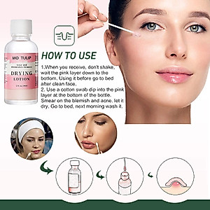 MO TULIP Acne Drying Lotion, Overnight Acne Acid and Acne Spot Treatment for Face and Body, Pimple Lotion Spot Treatment, Dry Out Pimples, Blemishes, and Clean pores (1OZ)