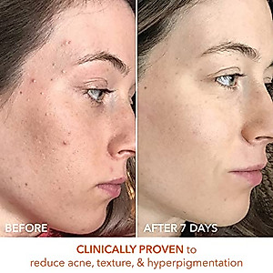 Dr. Dennis Gross Alpha Beta Universal Daily Peel: for Uneven Tone or Texture and Fine Lines or Enlarged Pores, (5 Treatments)