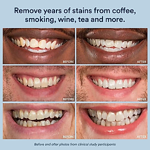 Auraglow 35% Teeth Whitening Gel Syringe Refill Pack, 35% Carbamide Peroxide, 30 Whitening Treatments, (3) 5mL Whitening Gel Syringes, Sensitive Teeth Whitening