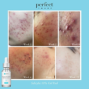 Salicylic 10% Gel Peel, Breakout and Pore Minimizer and Cleanser, 15-30 Full Facial Chemical Peels, 1 fl oz. e, 30 mL – Perfect Image