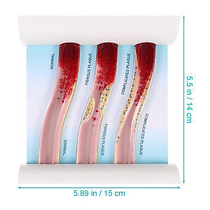 Human Body Skeleton Anatomical Model Low- Density Lipoprotein Blood Vessel Model