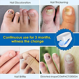 Nail Fungus Cleaning Light Device, FSA or HSA eligible Nail Fungus for Damaged Discolored Thick Toenails & Fingernails, Effective Rechargeable Nail Fungus Remover for Home Use