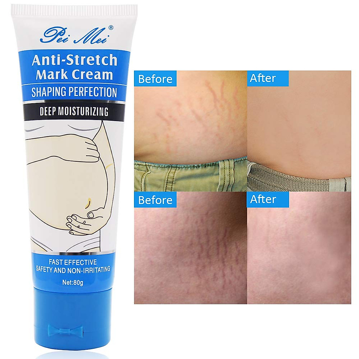 Stretch Mark Cream, Stretch Mark Remover, Stretch Mark Cream Pregnancy, Stretch Mark Removal Cream Maternity Repair, Repair Scar Cream Slackline Abdomen for All Skin Types