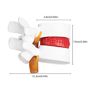 LVCHEN Disc Herniation Model - Human Lumbar Disc Herniation Spine Model 1.5X Intervertebral Disc Model Anatomical Vertebrae Disc Model with Elastic Software
