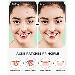 ZATKTK Acne Pimple Patch (180 Counts 4 Sizes), Invisible Hydrocolloid Acne Patch with Tea Tree Oil & Calendula Oil, Acne Spot Healing Patch Zit Patches for Face