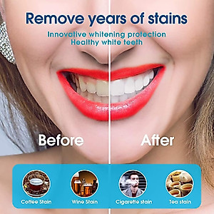 N Noble One Teeth Whitening Device with LED Red Lights Therapy, 32 LED Teeth Whitening Light, Enhancer Light Trays, 16 Minute Timer (White)