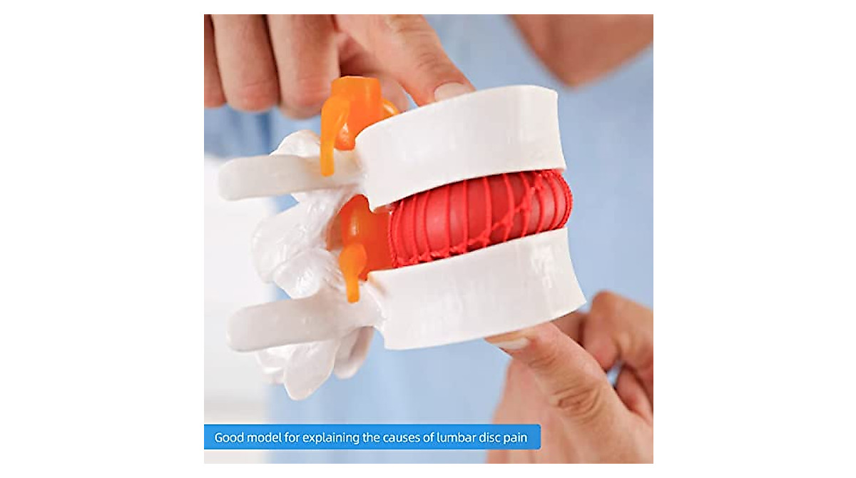 faruijie Disc Herniation Model - 1.5X Lumbar Herniated Disc Model ...