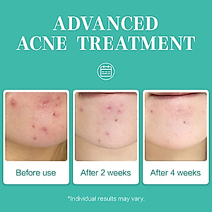 PROYA Facial Peels for Oil Skin, Contains Double AHA, Salicylic Acid, Azelaic Acid, with BASF Controlled Release Technology, Gentle Facial Exfoliator for Blackheads, Large Pores, Wrinkles & Fine Lines, Deep Cleanser 2.7 oz